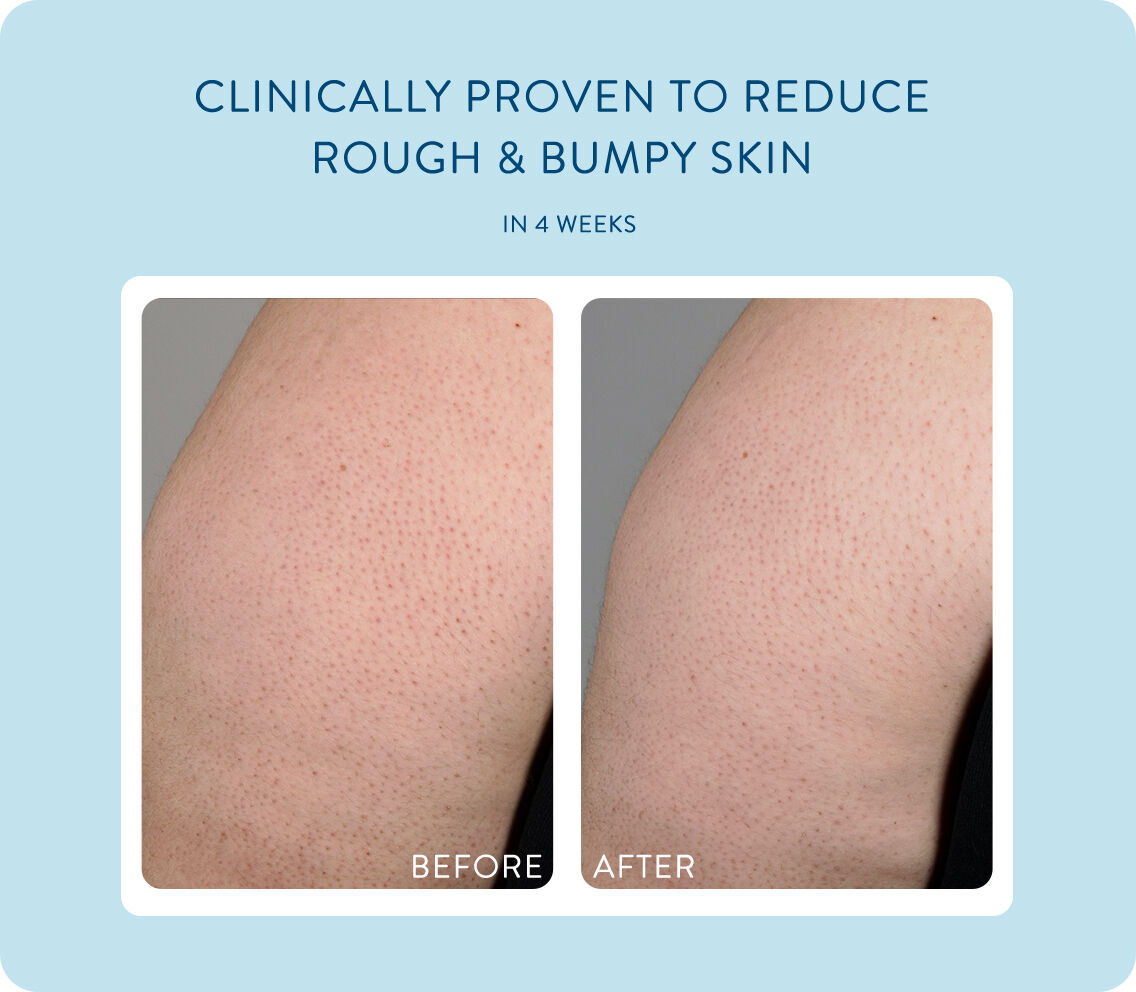 Rough and Bumpy | Cetaphil US